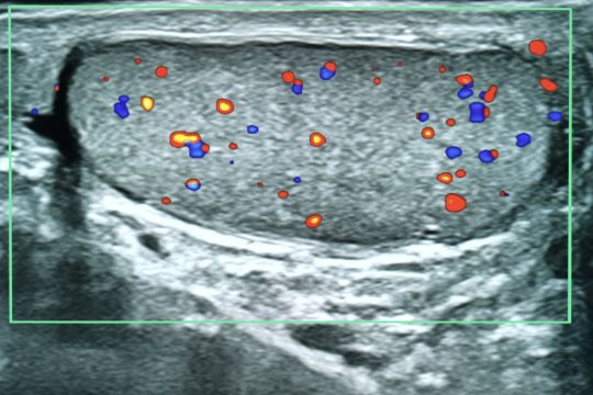 Uvod u ultrazvuk testisa: Šta je to i zašto se radi?